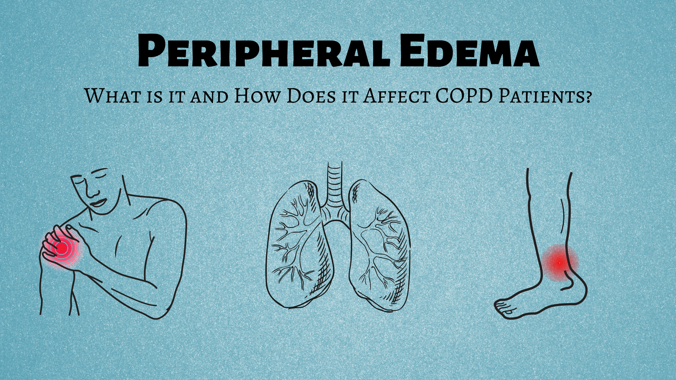 What is Peripheral Edema and Why is it a Concern for COPD Patients ...